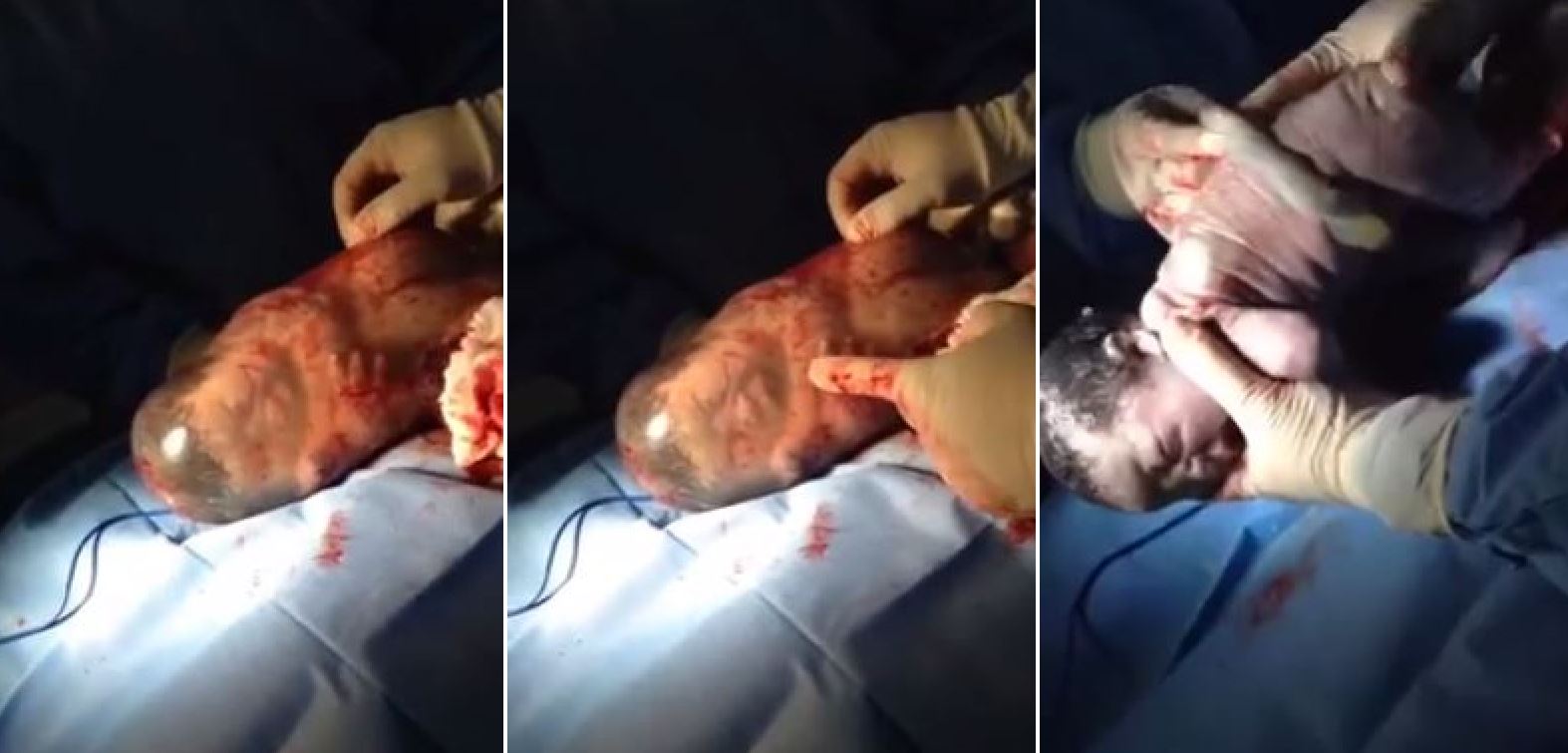 Doctors remove amniotic sac after baby is born ‘en caul’ in...